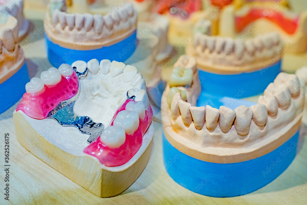 False jaws on table of the orthodontist. Several options for dental ...