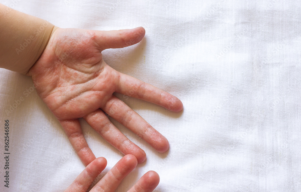 Red rash on children's hands on a white background, an allergic ...