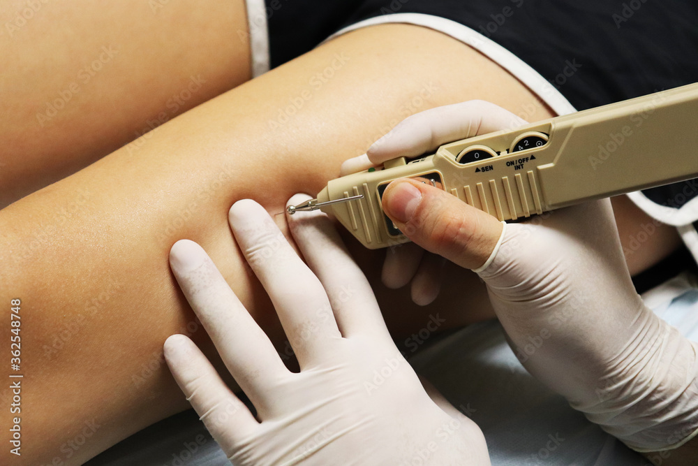 Neuromodulation of a trigger point using a pointer device. Stock Photo ...