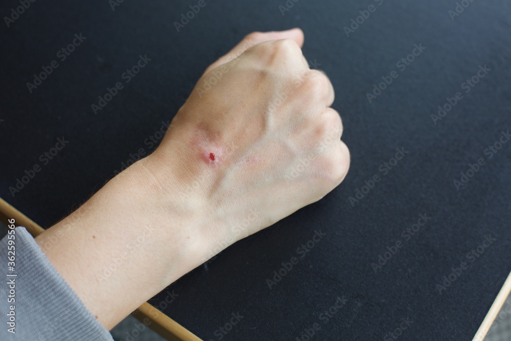 Foto de Squamous cell carcinoma in light 30 year old female hand do ...