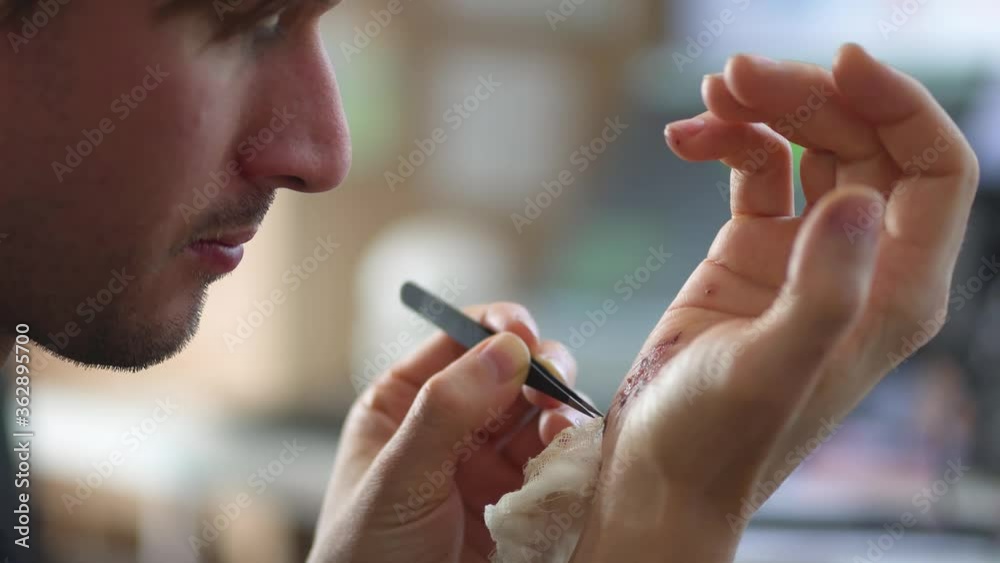 Man cleaning a bleeding wound under the skin after the accident ...