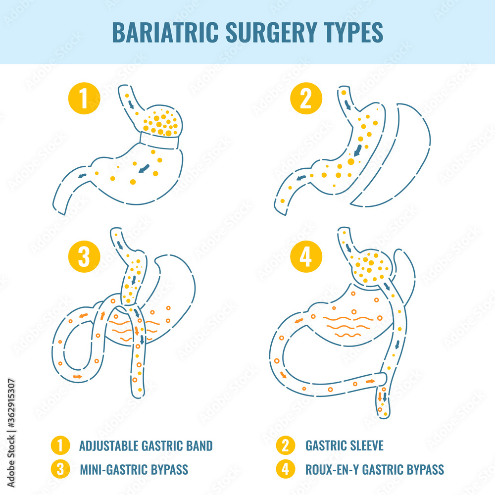 Types of bariatric surgery weight loss procedures- gastric bypass ...