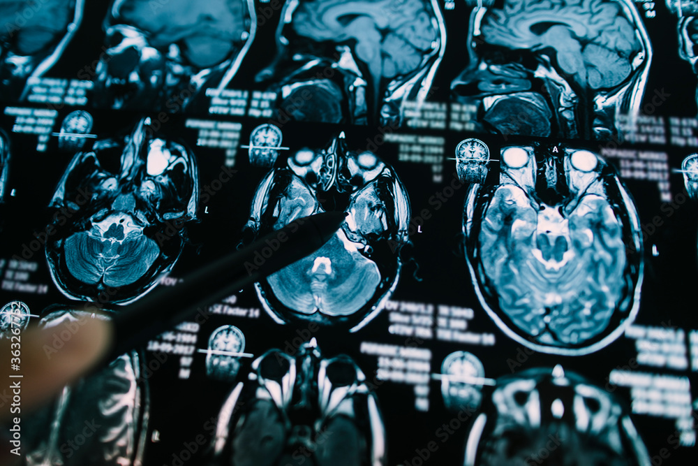 Pointing on magnetic resonance scan of the brain. X-ray scan of the ...