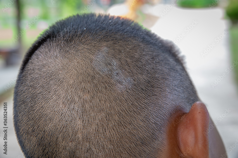 Close-up skin head , scalp, photos of dermatitis and eczema, skin ...