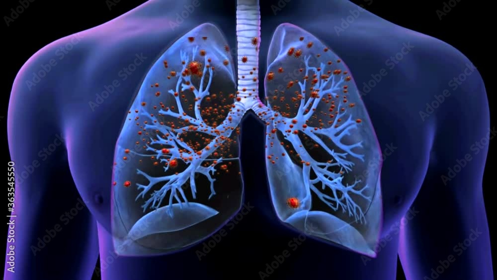 Realistic 3D footage animation of the severe acute respiratory syndrome ...