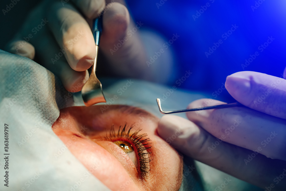 The operation on the eye. Cataract surgery. Vision correction. Stock ...