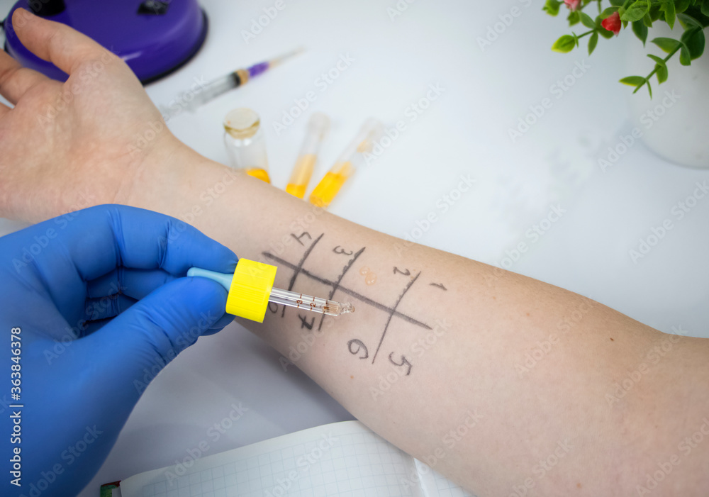 An allergist doctor in the laboratory conducts a prik allergy test ...