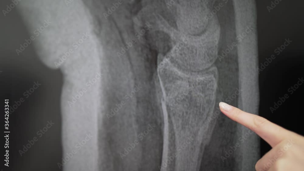 X-ray of a broken arm in a gypsum. The doctor shows the patient the ...