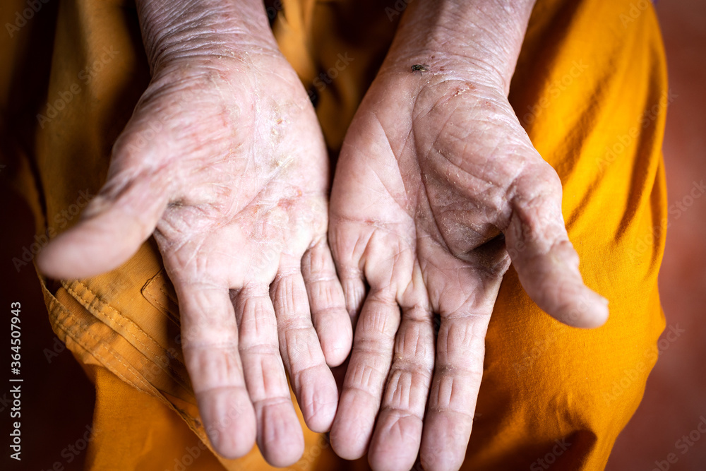 Psoriasis,Atopic dermatitis,dry skin,rash and red mark from scratching ...