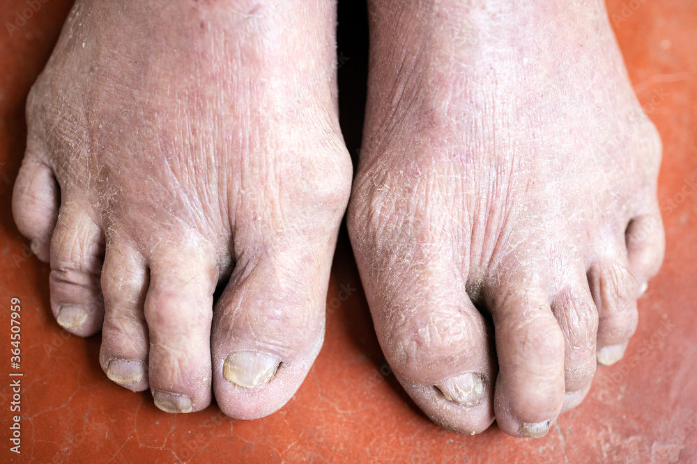 Psoriasis,Atopic dermatitis,dry skin of the toes,cracked skin of feet ...