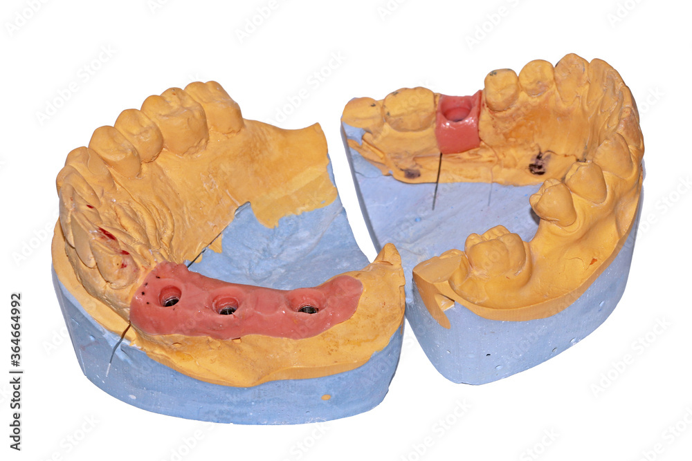 Laboratory gypsum models with artificial gums and implants. Different ...