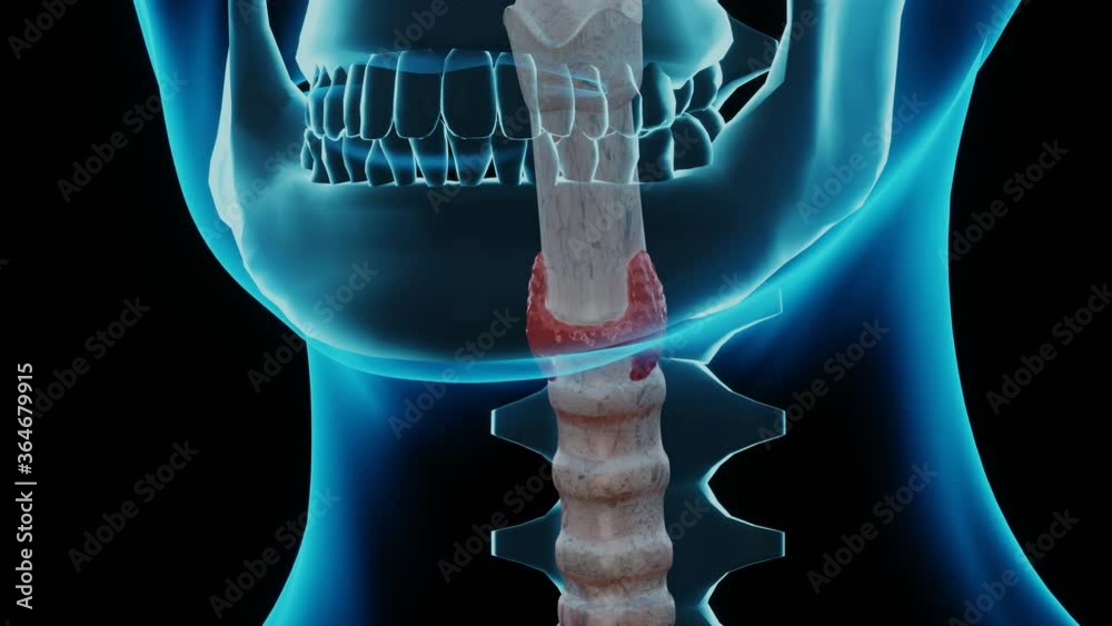 Nodular goiter in human body. 3D render animation of tissue problem ...