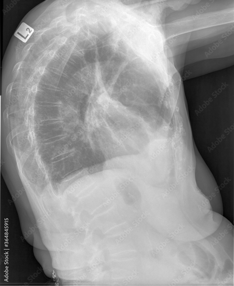 Chest x-rays durring lungs Tuberculosis also called as MTB or TB .Side view. Stock Photo | Adobe ...