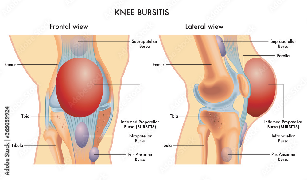 Medical illustration of a knee with an inflamed prepatellar bursa (BURSITIS) viewed frontally ...