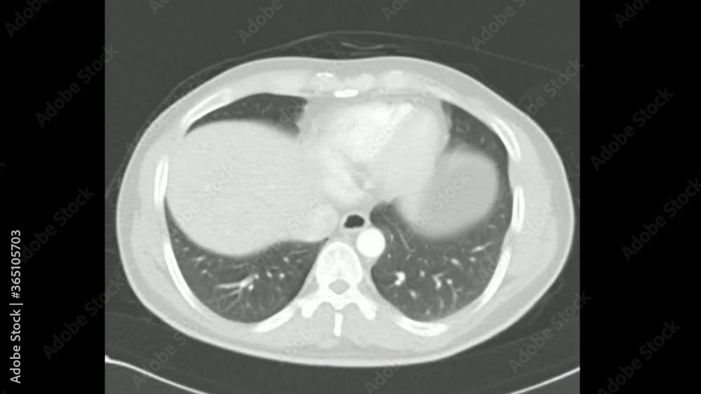 Computed Tomography scan (CT scan) of the chest lung window with oral ...