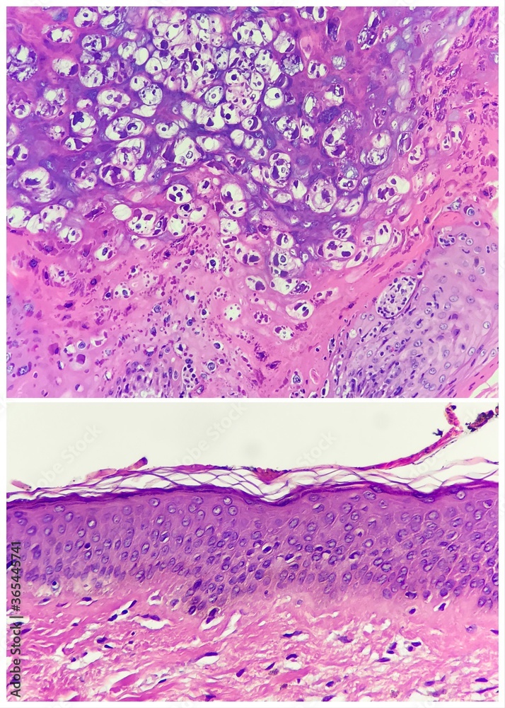 Photo of verruca vulgaris (upper), demonstrates keratohyaline granule ...
