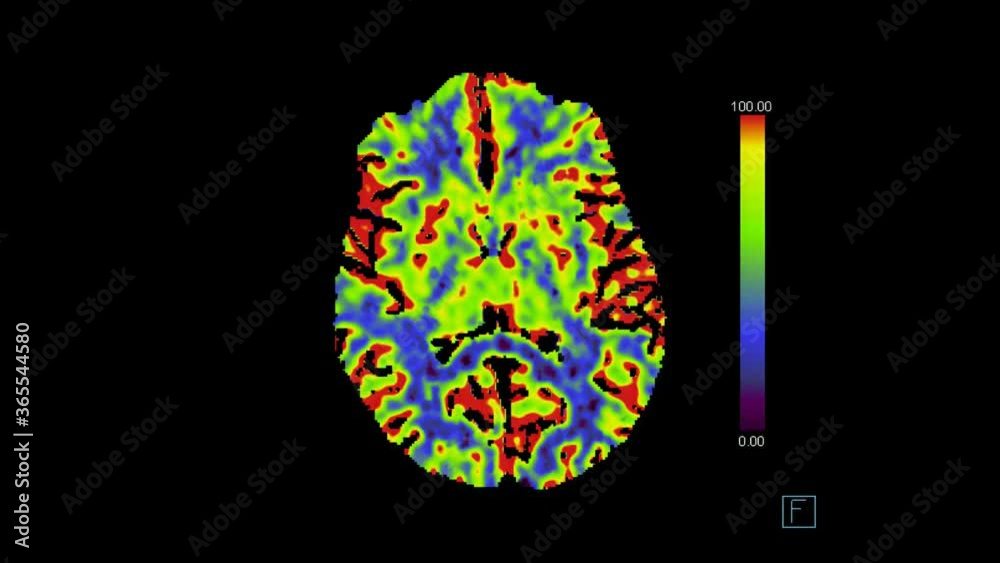 Vídeo do Stock: Computed Tomography of the human brain perfusion study ...