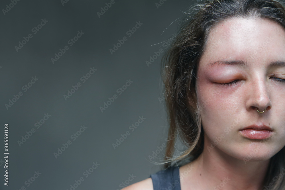 Young caucasian woman with a swollen eye from a wasp's sting. Allergy ...