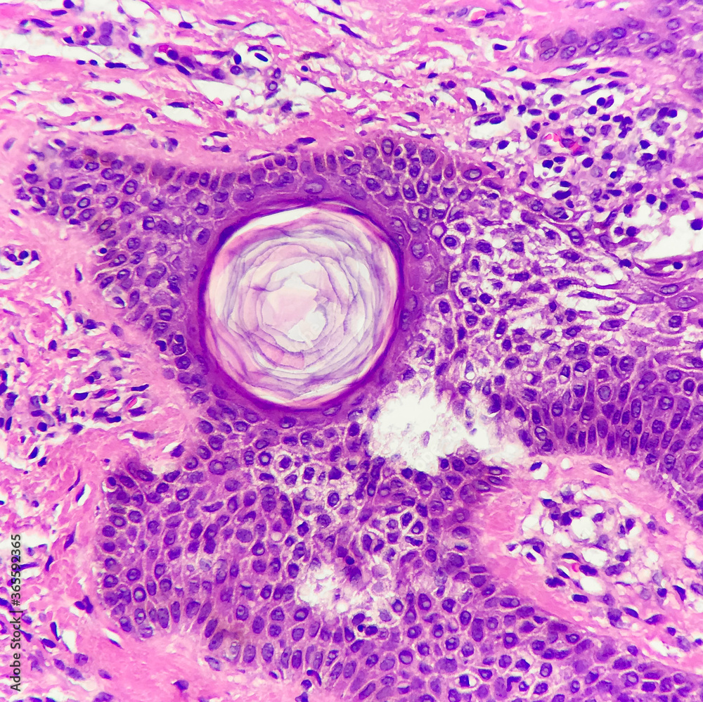 Photo of keratin pearl in seborrheic keratosis, high magnification ...