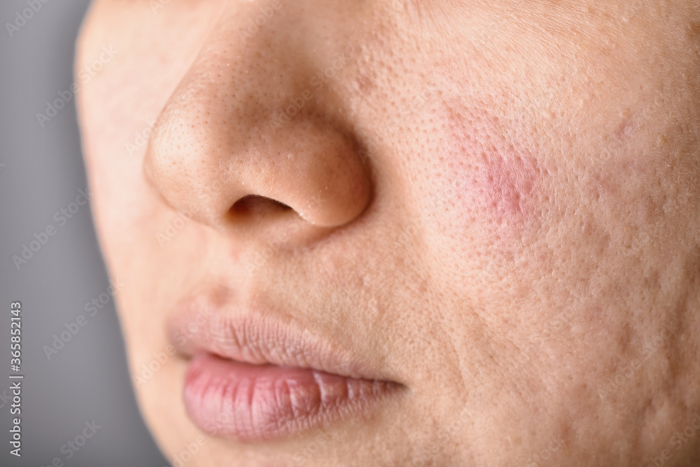 Skin problem with acne diseases, Close up woman face with acne marks ...