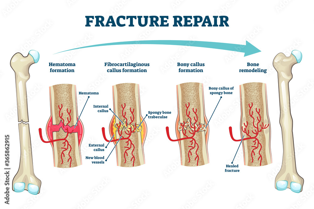 Fracture repair as educational bone remodeling formation vector ...
