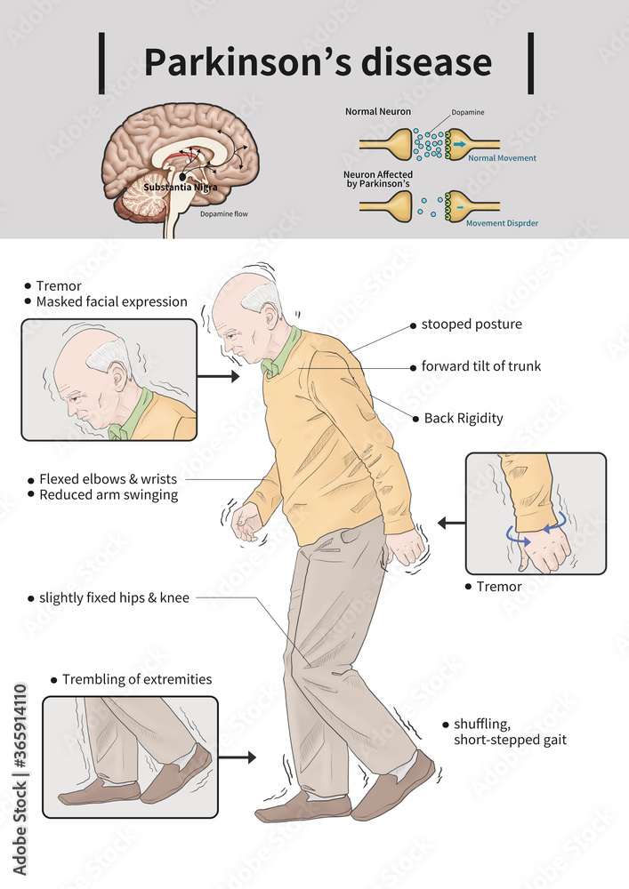 Medical illustration of the causes and symptoms of Parkinson's disease ...