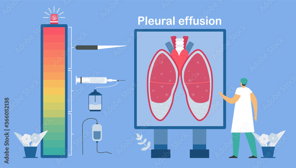 Level of treatments. Pleural effusion is collection of excess fluid ...