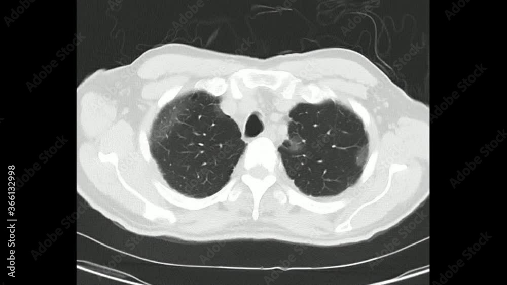 Computed Tomography of the chest (high resolution CT chest) in a ...