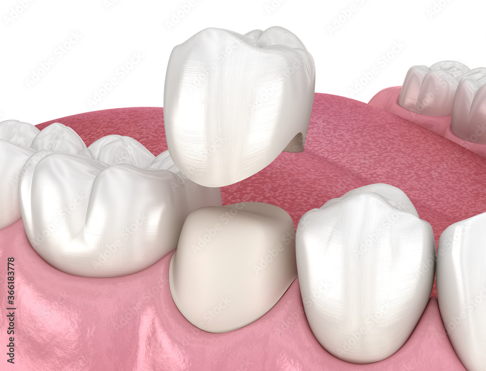 Preparated premolar tooth and dental crown placement. Medically ...