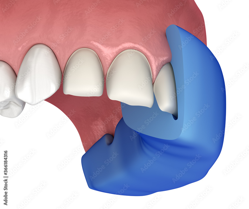 Cross-section of Mock-up dental key and prepareted incisor. Medically ...