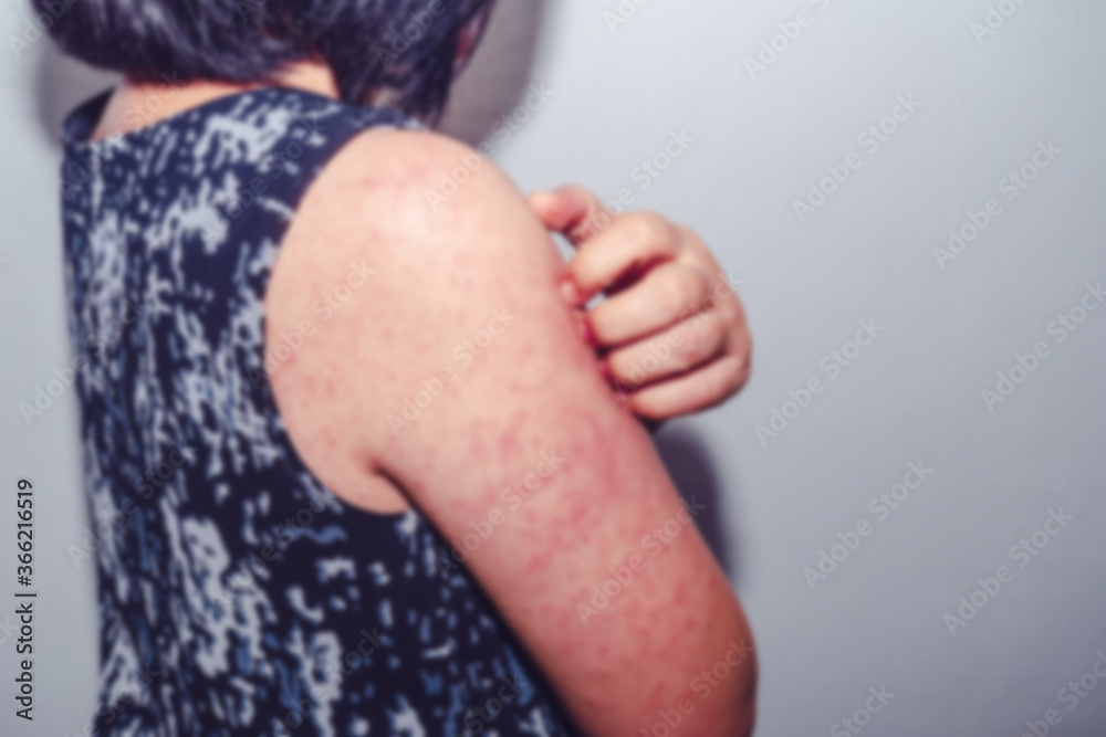 Blurred images of dermatitis from the measles virus, a woman with ...