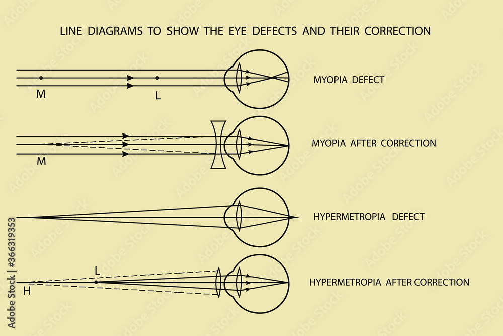 diagrams to the defects of human eye and their correction Stock Vector ...