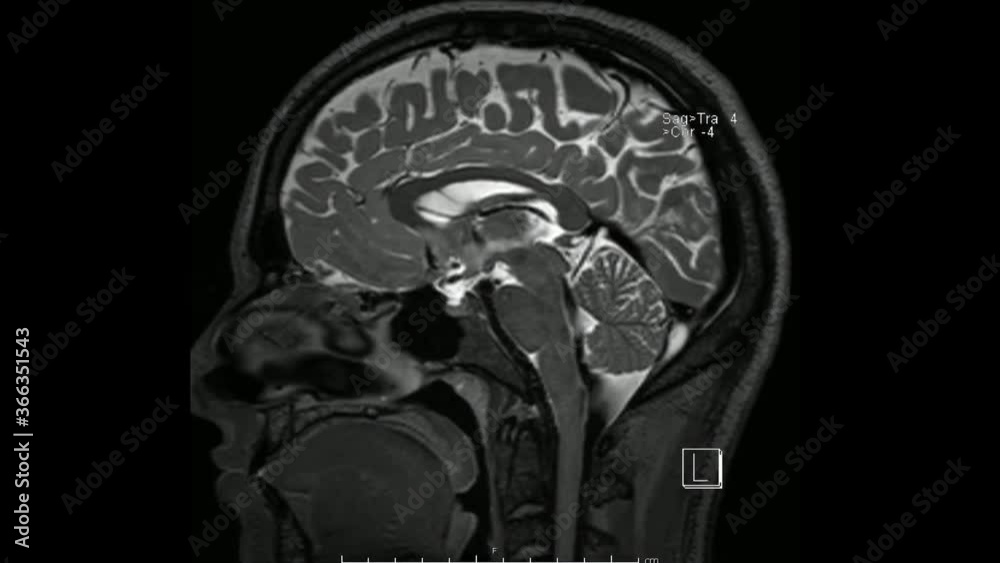 Magnetic resonance images of the brain (MRI brain) sagittal T2 weighted ...