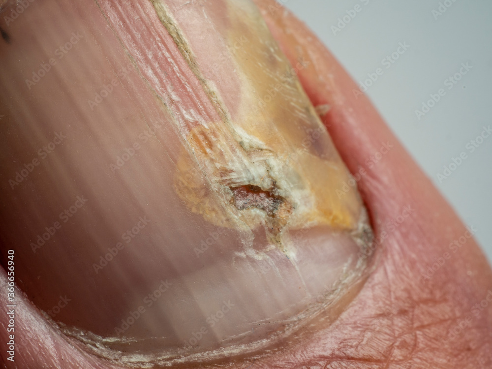 Nail infections caused by fungi such as: onychomycosis also known as ...