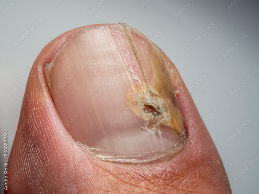Foto de Nail infections caused by fungi such as: onychomycosis also ...