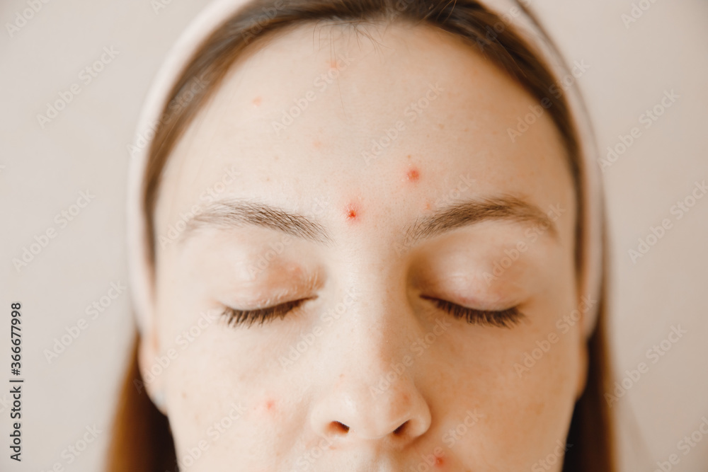 Skin of face of young woman is affected by chickenpox, acne defects ...