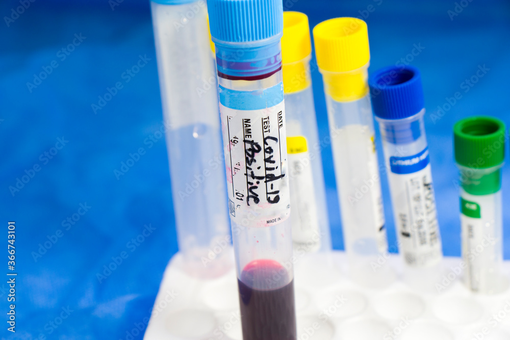 Corona virus and Covid-19 positive test samples. Tubes of blood. Stock ...