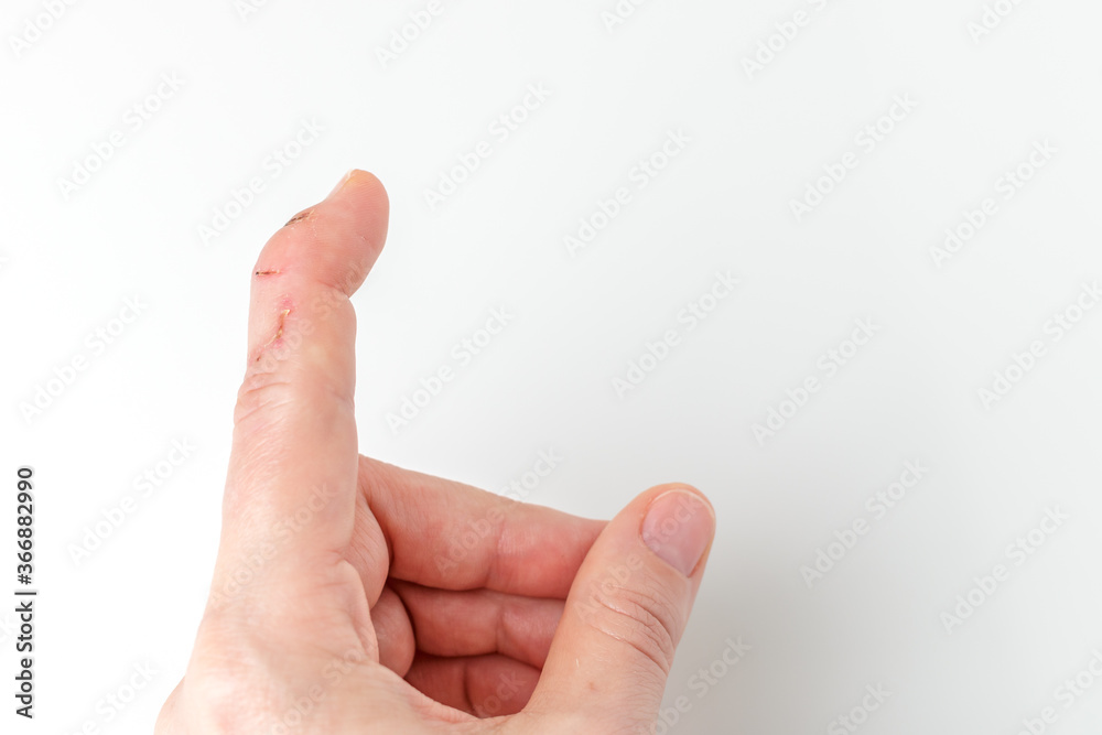 cut index finger with a extensor tendon injury, mallet finger ...