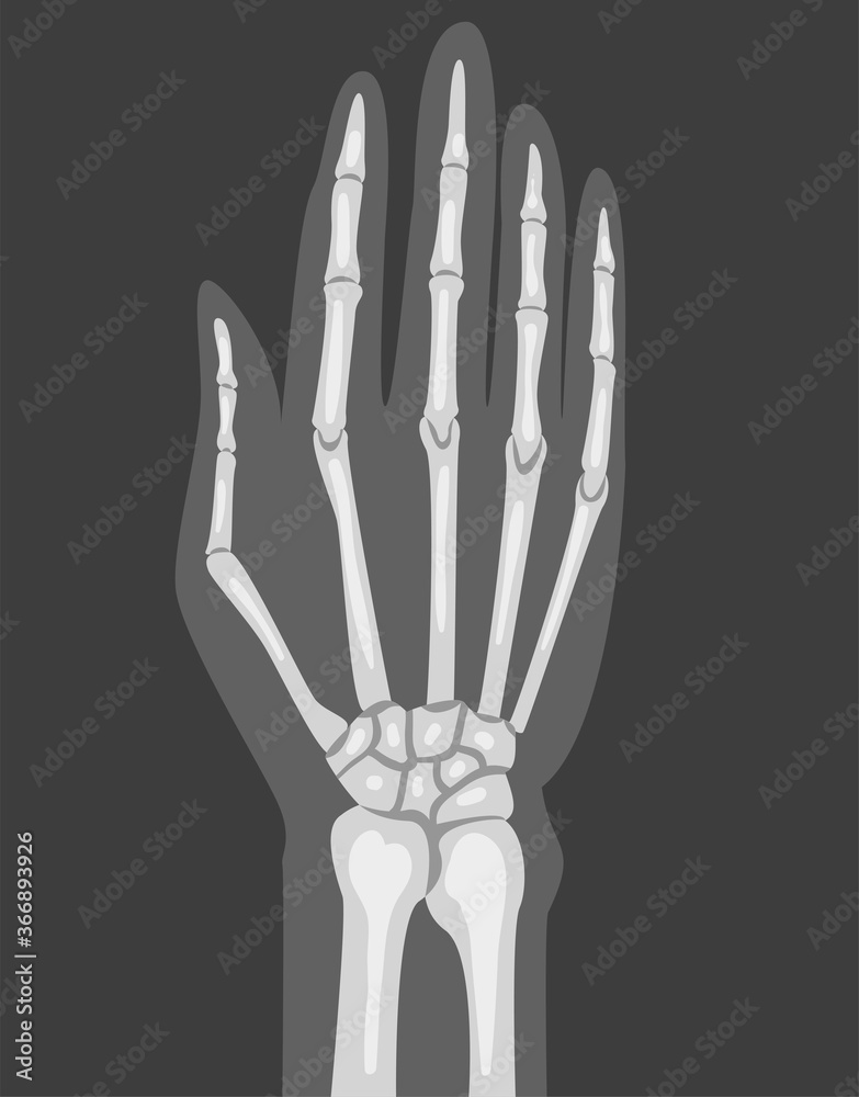 X-ray Film of Hand Vector Illustrated Image for Educational Purpose ...