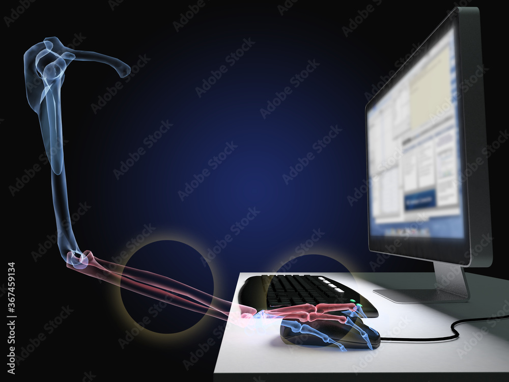 Carpal Tunnel Syndrome,Skeletons and computer, Arms bones on Office ...