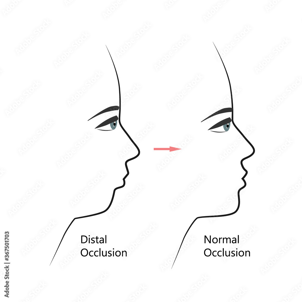 Distal bite profile before and after orthodontic treatment. Human with ...