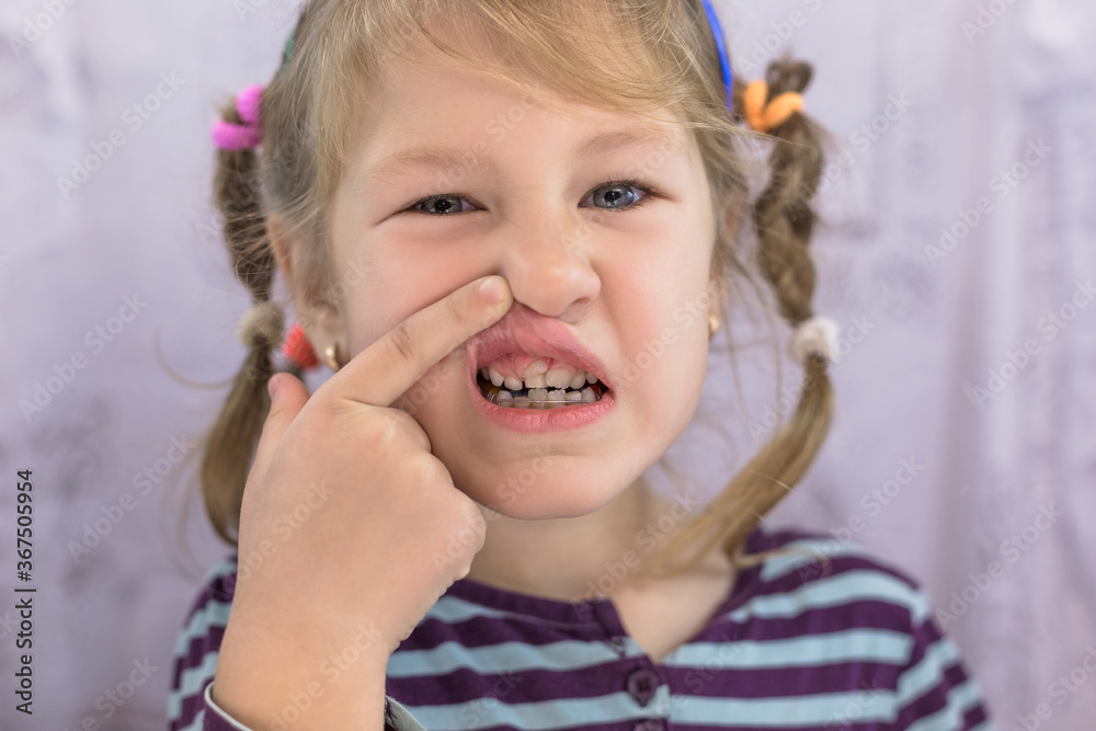 Adult permanent teeth coming in front of the child's baby teeth: shark ...