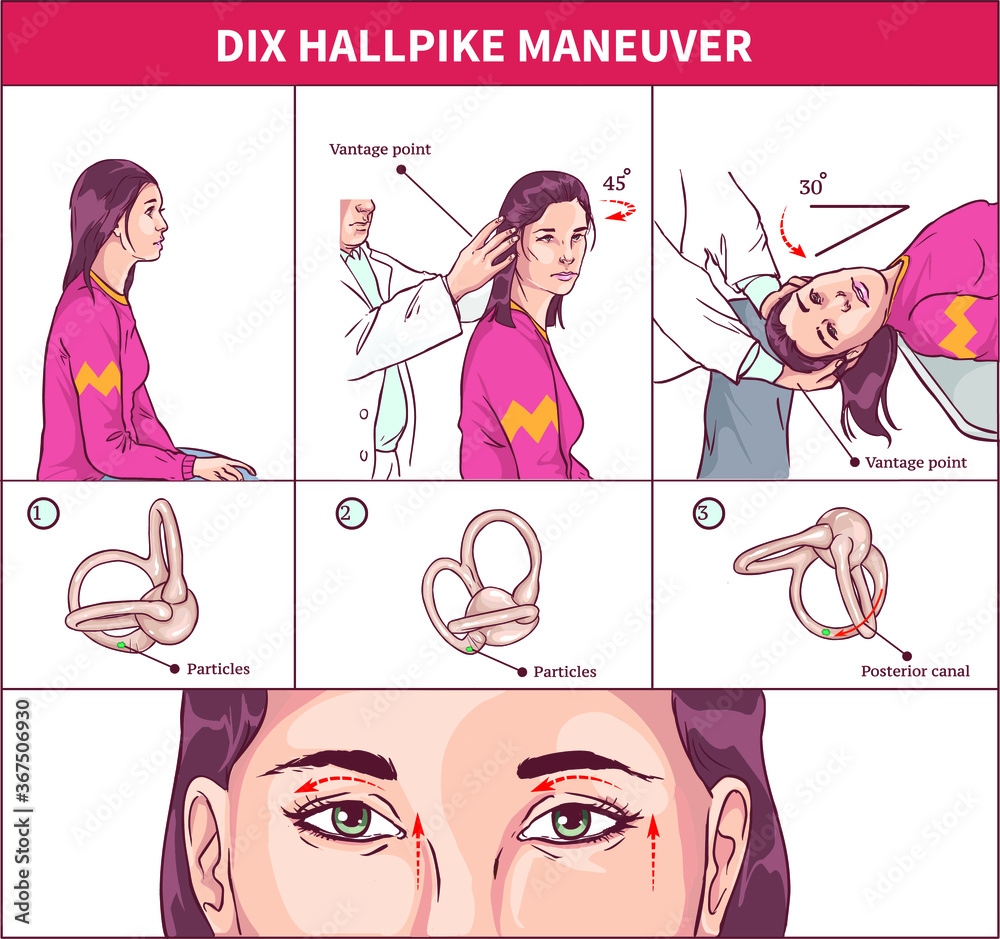 Dix Hallpike Maneuver Vector illustration Stock Vector | Adobe Stock
