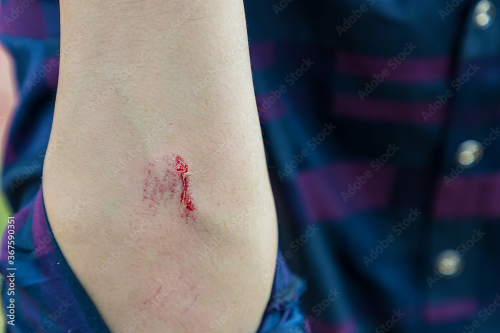 Injuries from falling in the garden. A man showing a lesion on his arm. Arm is wound from a ...