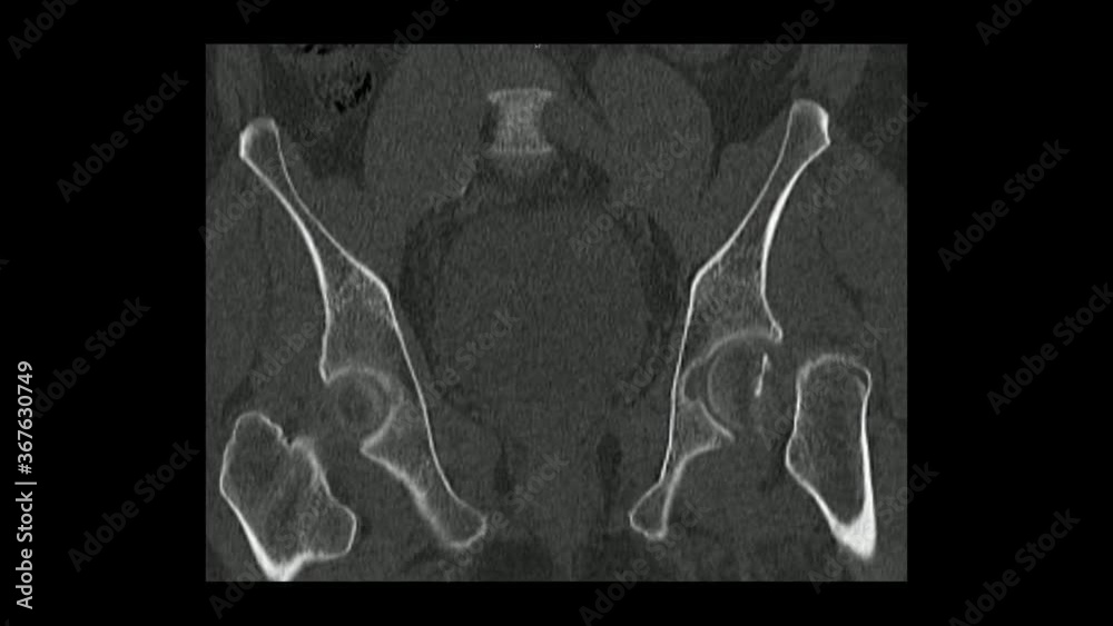 Computed Tomography of the pelvis in coronal plane showing left femur ...