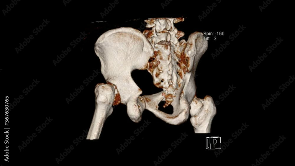 Computed Tomography Volume Rendering examination of the pelvis showing ...