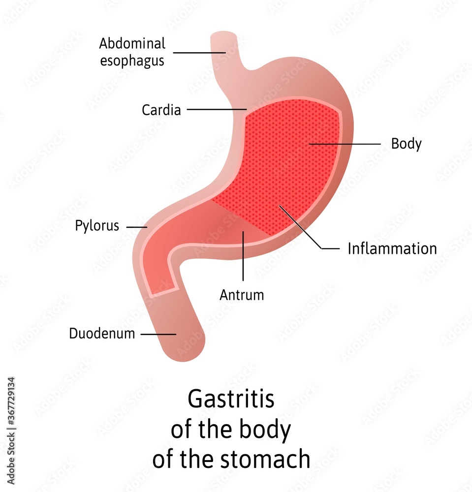 Location of Gastritis, body of it, an inflammation of the lining of the ...