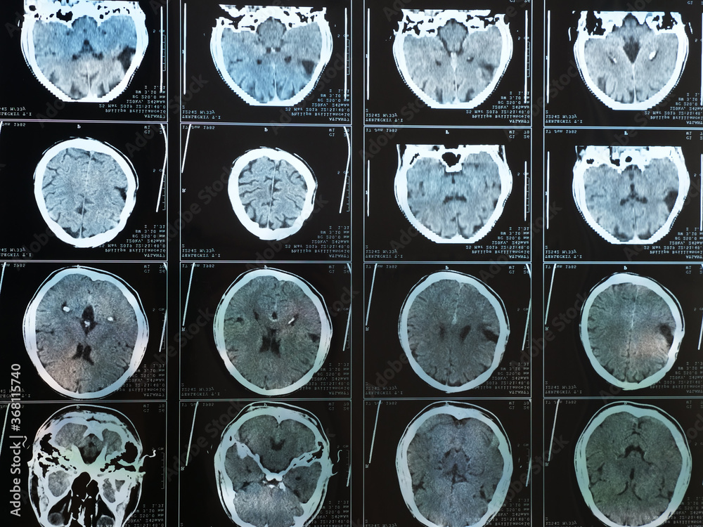 MRI of the braiMRI scan of the human brain after traumatic brain ...