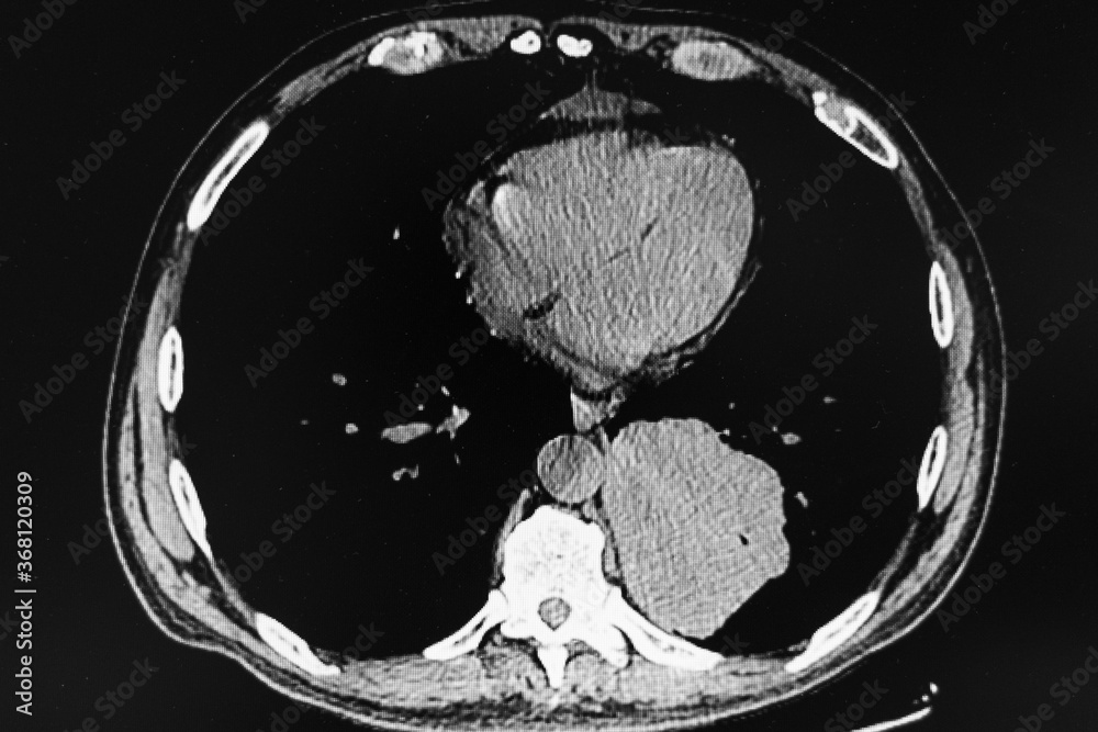 Chest CT Scan shows epidermoid (squamous cell carcinoma) on left lower ...