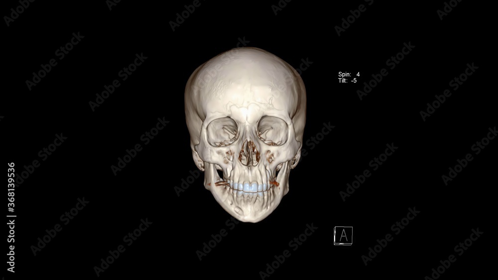 Computed Tomography of the Skull (facial bones) in 3D (CT VR facial ...